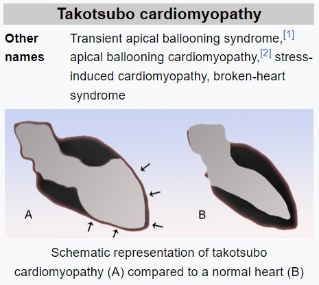 Broken Heart Syndrome - DOES GOD EXIST? TODAY